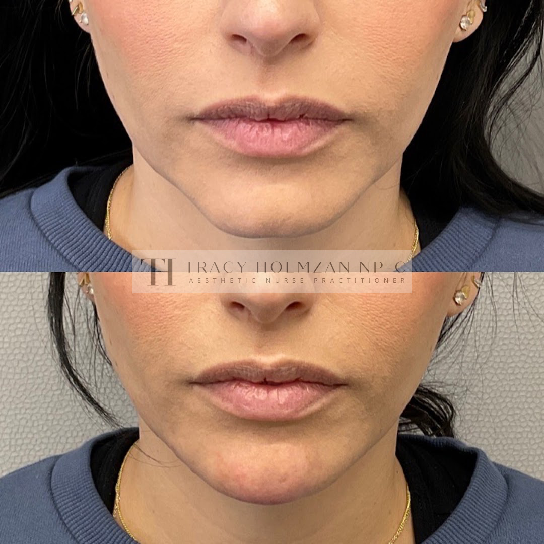 Chin Filler Before After See Real Results At Ritual Chin Filler Before After See Real Results At Ritual